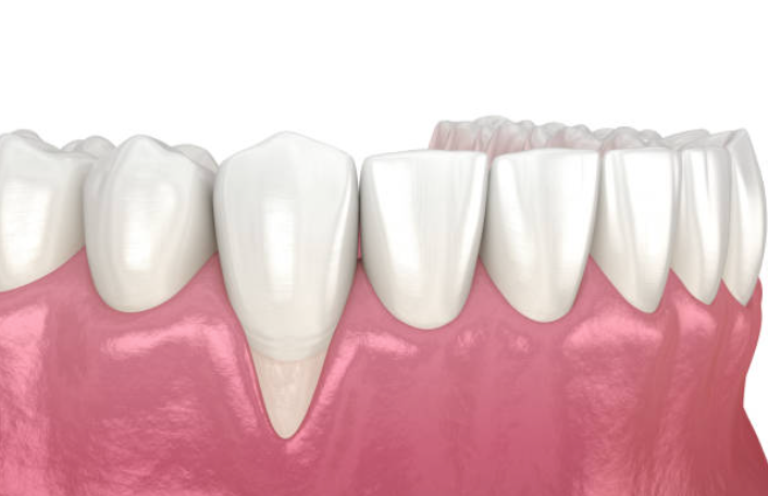 Gum Disease and Grafting / Pinhole Technique - Nanton Dental Care